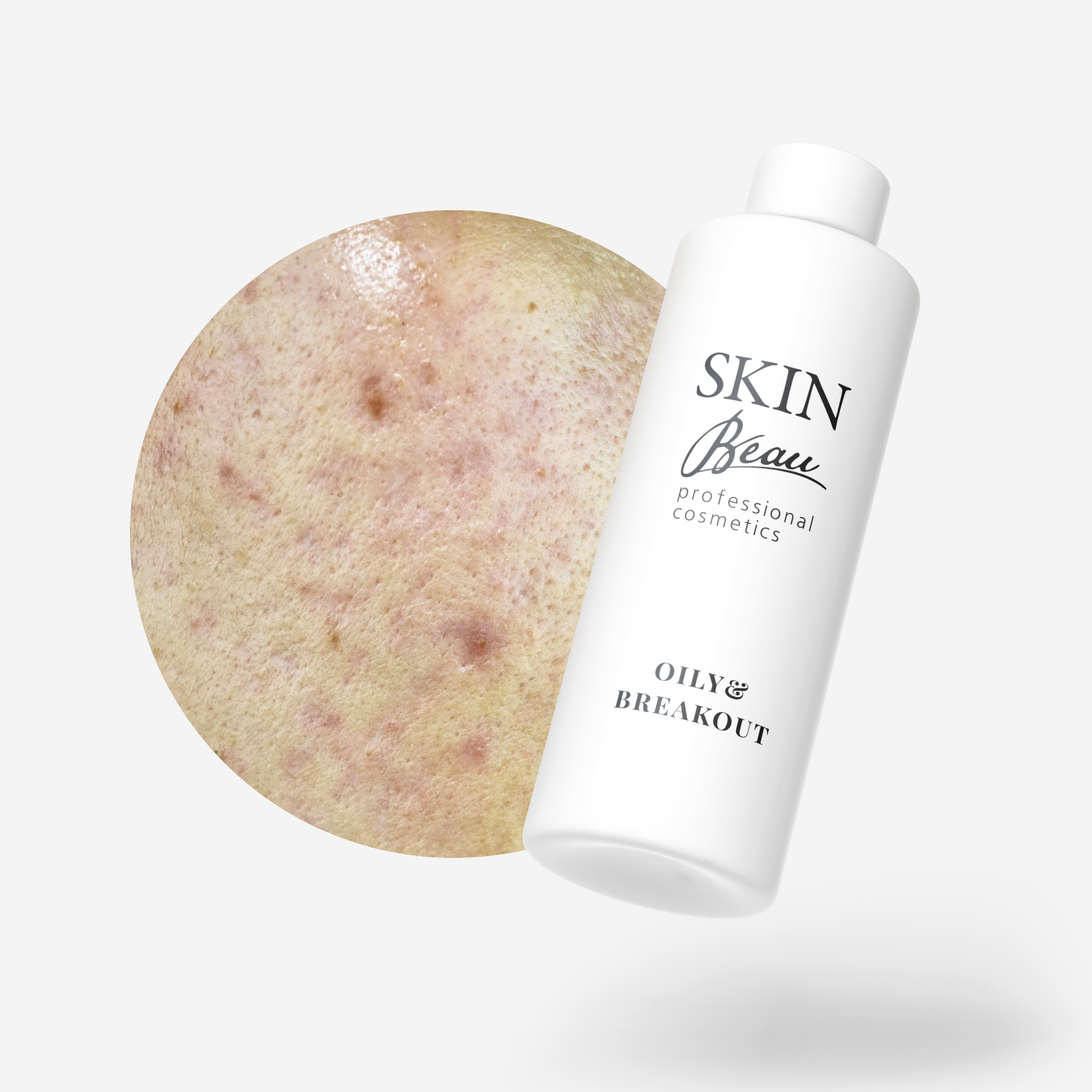 OILY & BREAKOUT – Skin Beau Cosmetics Store